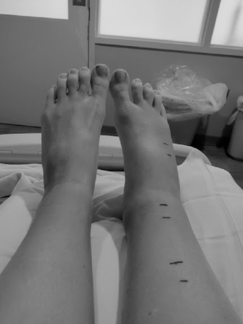 Everything To Know About A Copperhead Bite: My Experience