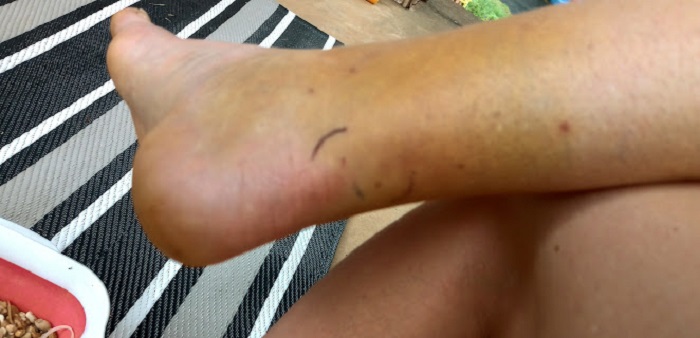 Everything To Know About A Copperhead Bite: My Experience